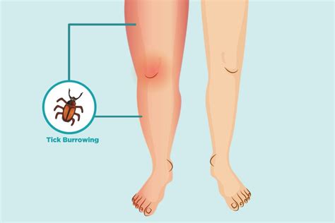 Lyme Disease Knee Replacement At Donald Lyman Blog