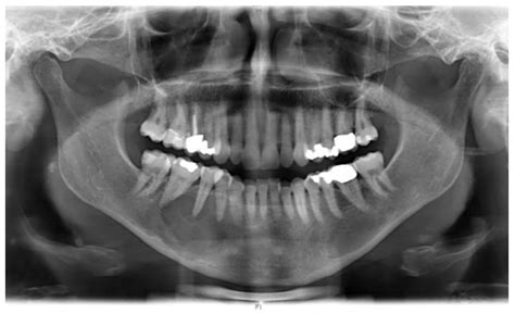 Hyperparathyroidism X Ray