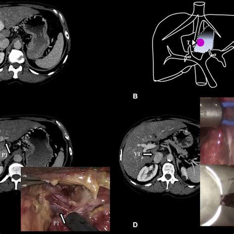 Pdf Laparoscopic Isolated Resection Of Caudate Lobe Segment 1 A