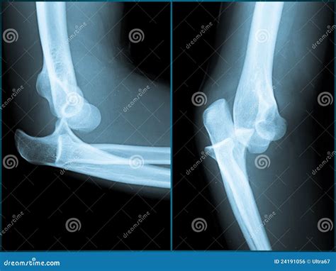 Elbow Anatomy Xray
