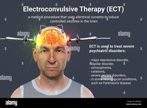 Electroconvulsive Therapy Procedure