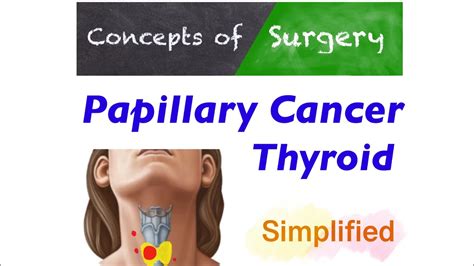 Thyroid Papillary Cancer Most Simplified Approach To Management Youtube