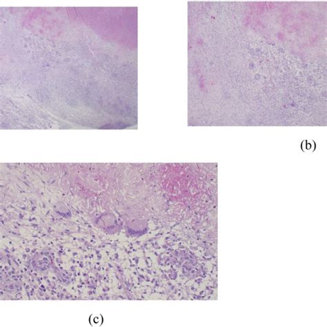 Brain Tuberculoma H And E Micrograph Images Sections Of Brain Tissue