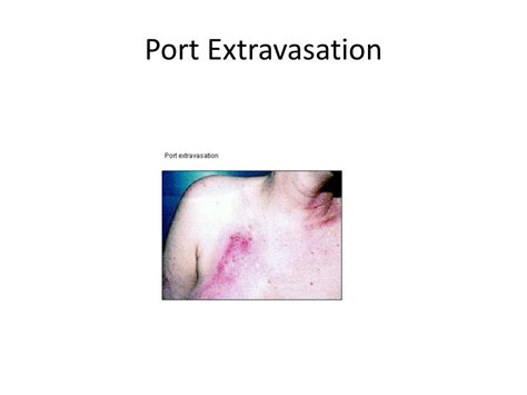 Ppt Vesicant Infusions A Presentation For King Edward Vii Memorial Hospital Bermuda 23