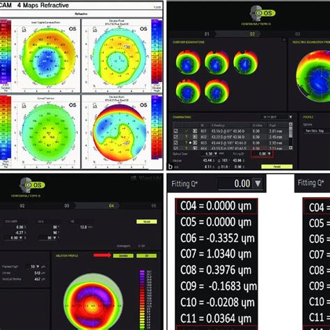 Case 4 A Refractive 4 Map On Pentacam Showing Small Zone Of Download Scientific Diagram