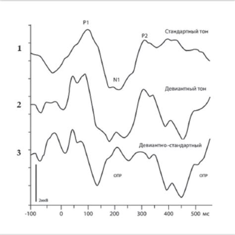 Pdf Auditory Neuropathy Auditory Neuropathy Spectrum Disorders