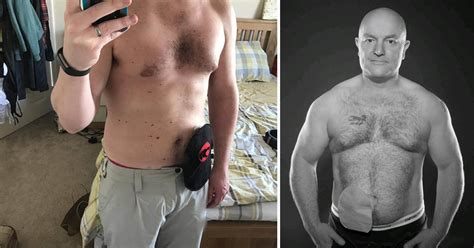 Men With Ibd Answer Questions On What Its Like To Live With A Stoma