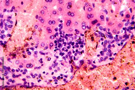 Coccidia In Liver Photomicrograph Showing Intracellular Parasitic Protozoa Causing Hepatic