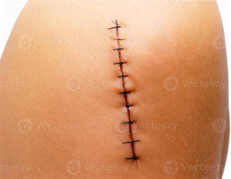 Close Up Of A Surgical Scar With Dissolvable Stitches Healing On Skin