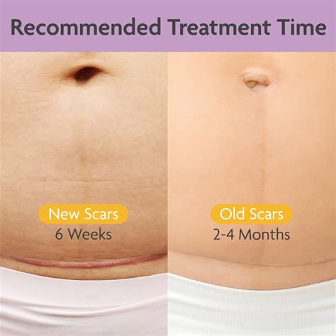 C Section Scar 2024