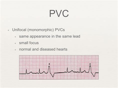 Ecg Interpretation Criteria Review Ppt Video Online Download