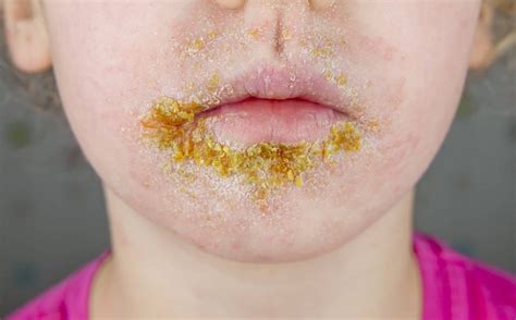 Impetigo Contagiosa Impetigo Rash Impetigo On Lips Dermatim