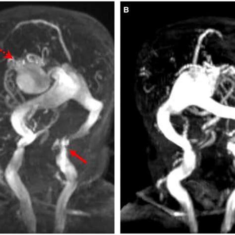 Magnetic Resonance Angiogram Images Show The Vgam Red Dotted Arrow