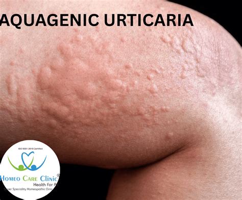 Aquagenic Urticaria Causes Symptoms And Homeopathy Treatment