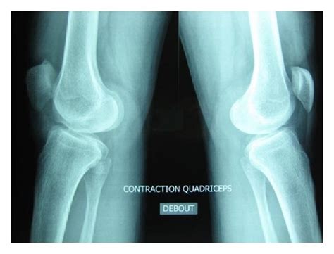 Comparative Weight Bearing X Ray Lateral View A Without Contraction