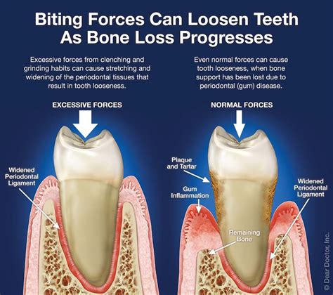 Loose Teeth And Bite Problems Coastal Periodontics And Implant Dentistry
