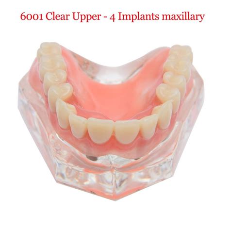 Dental Implant Teeth Teaching Model Overdenture Re Vicedeal