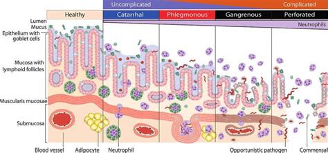 Acute Appendicitis Manifests As Two Microbiome State Types With Oral
