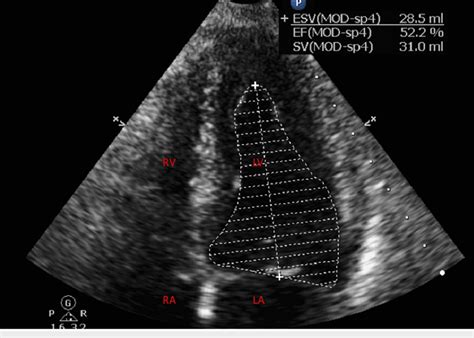 Transthoracic Echocardiogram Depicting The Heart Of The Patient