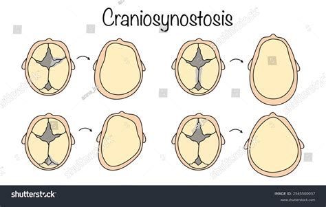 Newborn Suture Lines Over 2 Royalty Free Licensable Stock Illustrations And Drawings Shutterstock