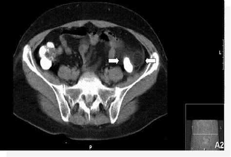The Ct Scan Shows An Epiploic Appendicitis Located At The Junction Of Download Scientific