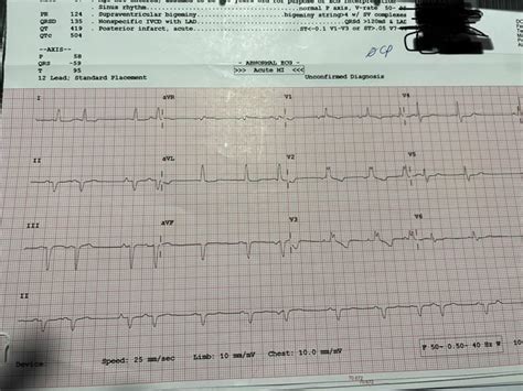 Incomplete Rbbb With Lad R Ekgs