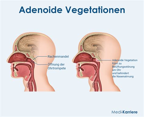 Anatomia Adenoide