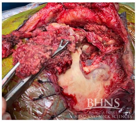 Temporal Bone Malignancy
