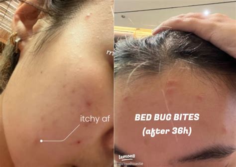 My Face Was Full Of Bites Singaporean Ends Up In Bangkok Hospital