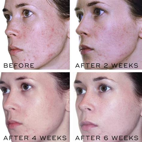 Face Serum Before Or After Retinol At Jeanette Bell Blog