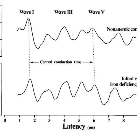 Representative Auditory Brainstem Responses At 6 Mo Recordings At 85 Download Scientific