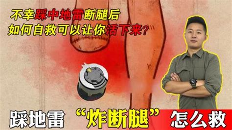 不慎踩中地雷被炸断腿怎么办？自救指南高清1080p在线观看平台腾讯视频