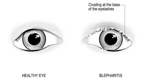 What Is Blepharitis Eye Infection Symptoms And Treatment Options