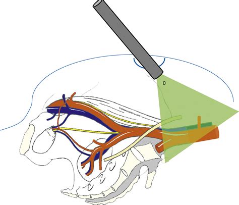 Optimizing The Approach For Lymph Node Dissection During Laparoscopic