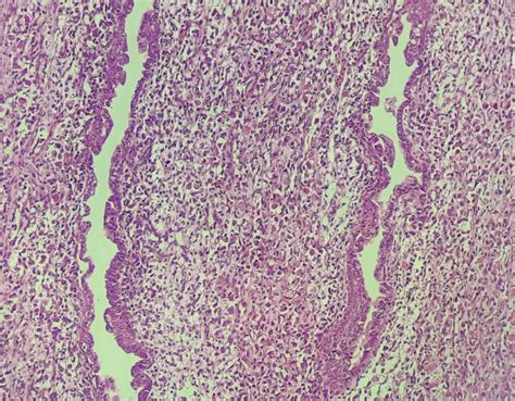 Dr Nirmalya Banerjee On Linkedin Uterine High Grade Adenosarcoma Is A