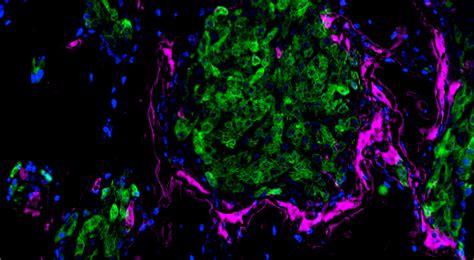 Tumor Osteoclast Spatiotemporal Coupling A Cell Behavior Target For Bone Metastasis Prevention