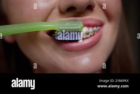 A Closeup Of A Person With Braces Brushing Their Teeth Highlighting