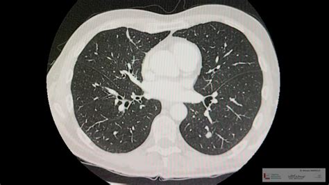 Alessio V Mariolo On Linkedin Thoracicsurgery Segmentectomy