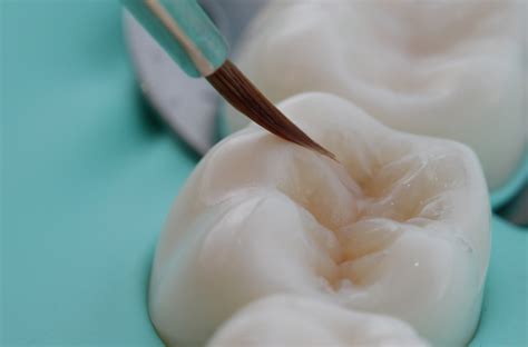 Dental Composite Posterior Teeth At Marcellus Meyers Blog