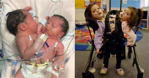 Conjoined Twins ‘defy Odds By Learning To Walk And Starting School