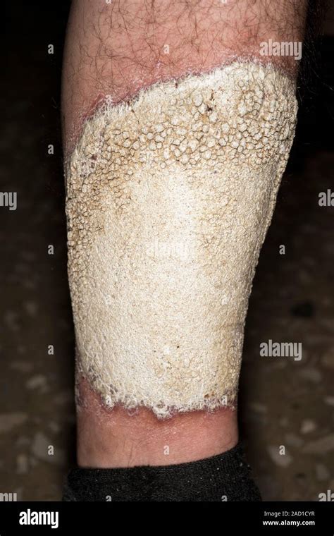 Ostraceous Psoriasis Patch Of Scaly Psoriatic Skin On The Front Of A