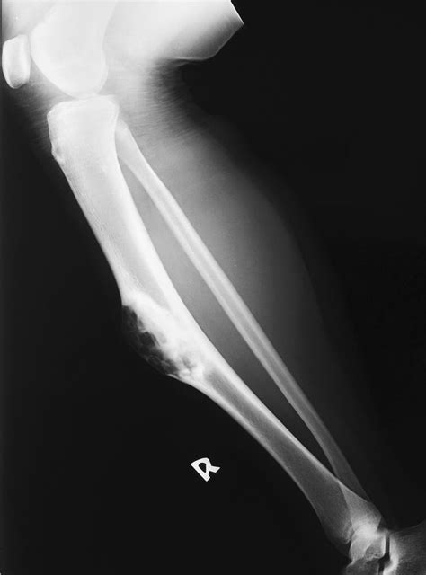 Osteofibrous Dysplasia Of The Tibia Radiology Case