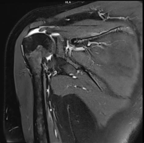 Supraspinatus Muscle Rupture Mri