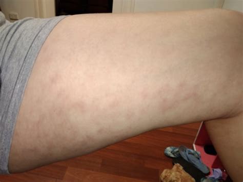 Inner Thigh Pimples Stretch Marks On Thighs Appearance Causes And
