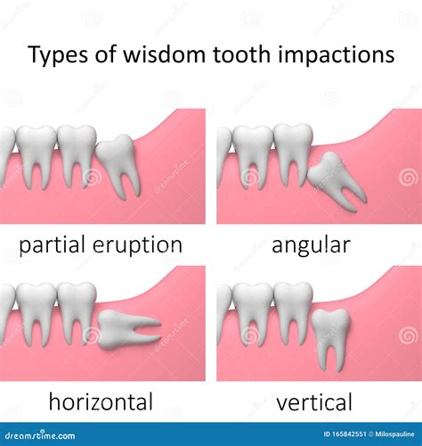 What Are The Different Types Of Wisdom Teeth At Michael Kennelly Blog