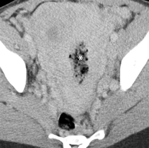 Endometritis Noncontrast Computed Tomography Scan From The Same Download Scientific Diagram