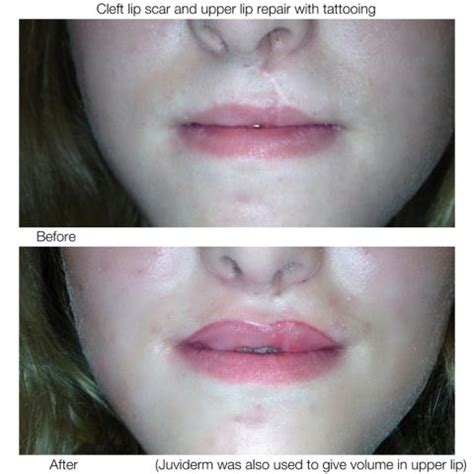 Lip Scar