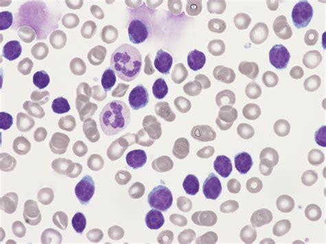 Chronic Lymphocytic Leukaemia Haematological Malignancy Diagnostic