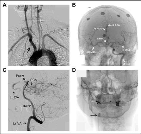 Figure 2 From Axillo Axillary Artery Bypass With Coil Embolization Of