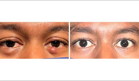Chalazion I And D With Steroid Injection Beach Eye Care Lasik And Vision Correction Coastal